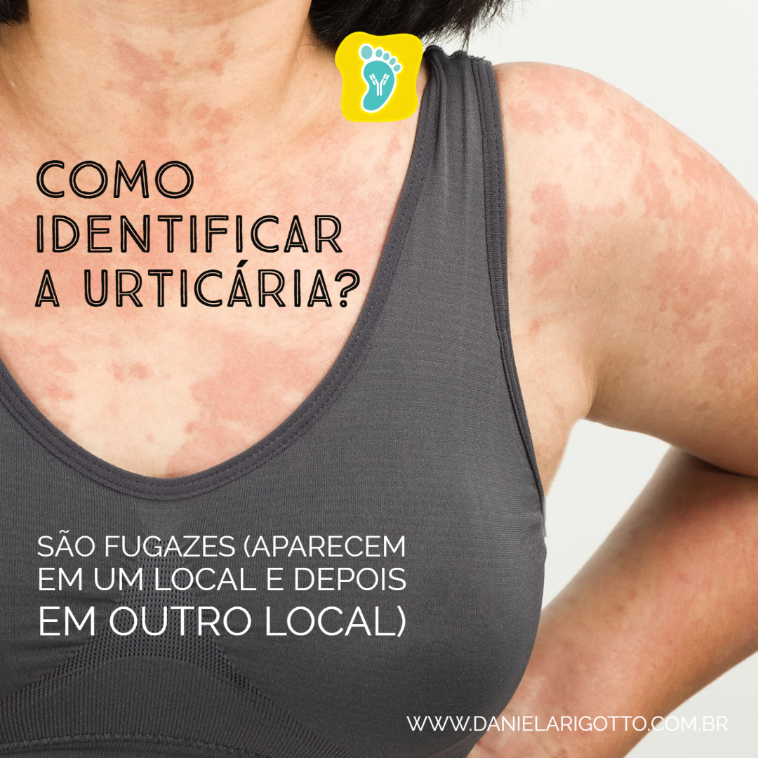 Como identificar a urticária? - Dra. Daniela T. Rigotto Bannwart